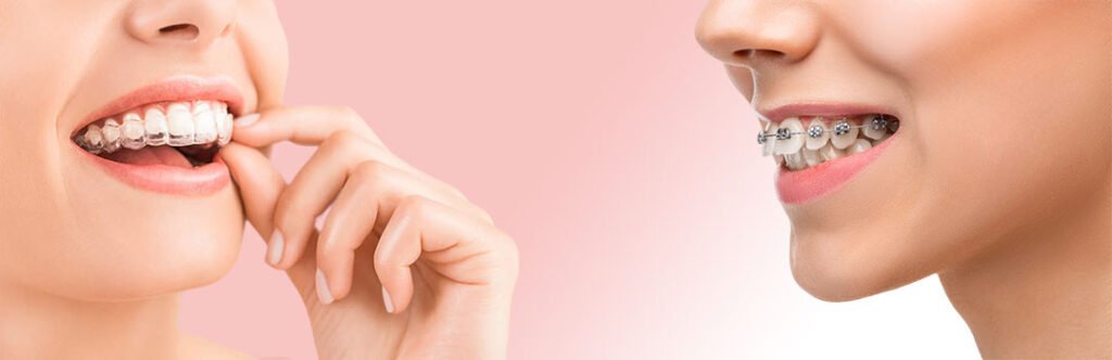 Braces & Aligners - Apex Dental & Implant Centre