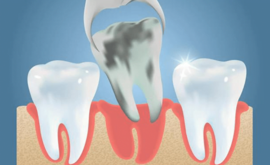 Wisdom Tooth Extraction at Apex Dental, Dwarka - Apex Dental & Implant ...